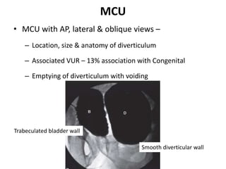 Bladder diverticulum | PPTX