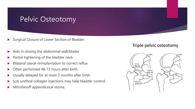 Bladder exstrophy | PPTX | Sexual Conditions | Sexual Health