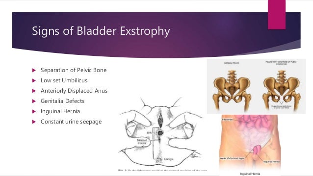 Bladder exstrophy