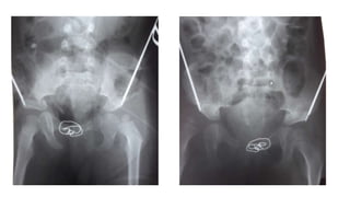 Bladder exstrophy and caudal duplication | PPT