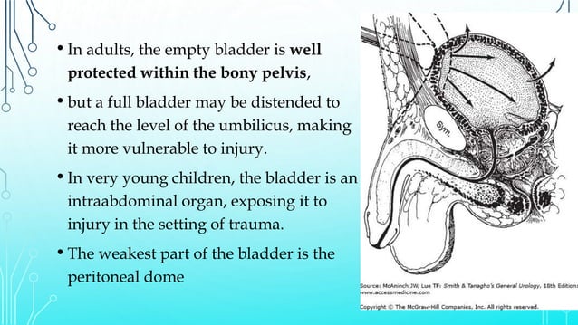 Bladder injuries | PPTX | Death, Injury, or Military Conflict ...