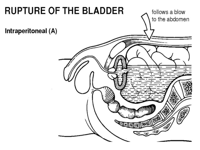 Bladder injury by dhanush | PPT