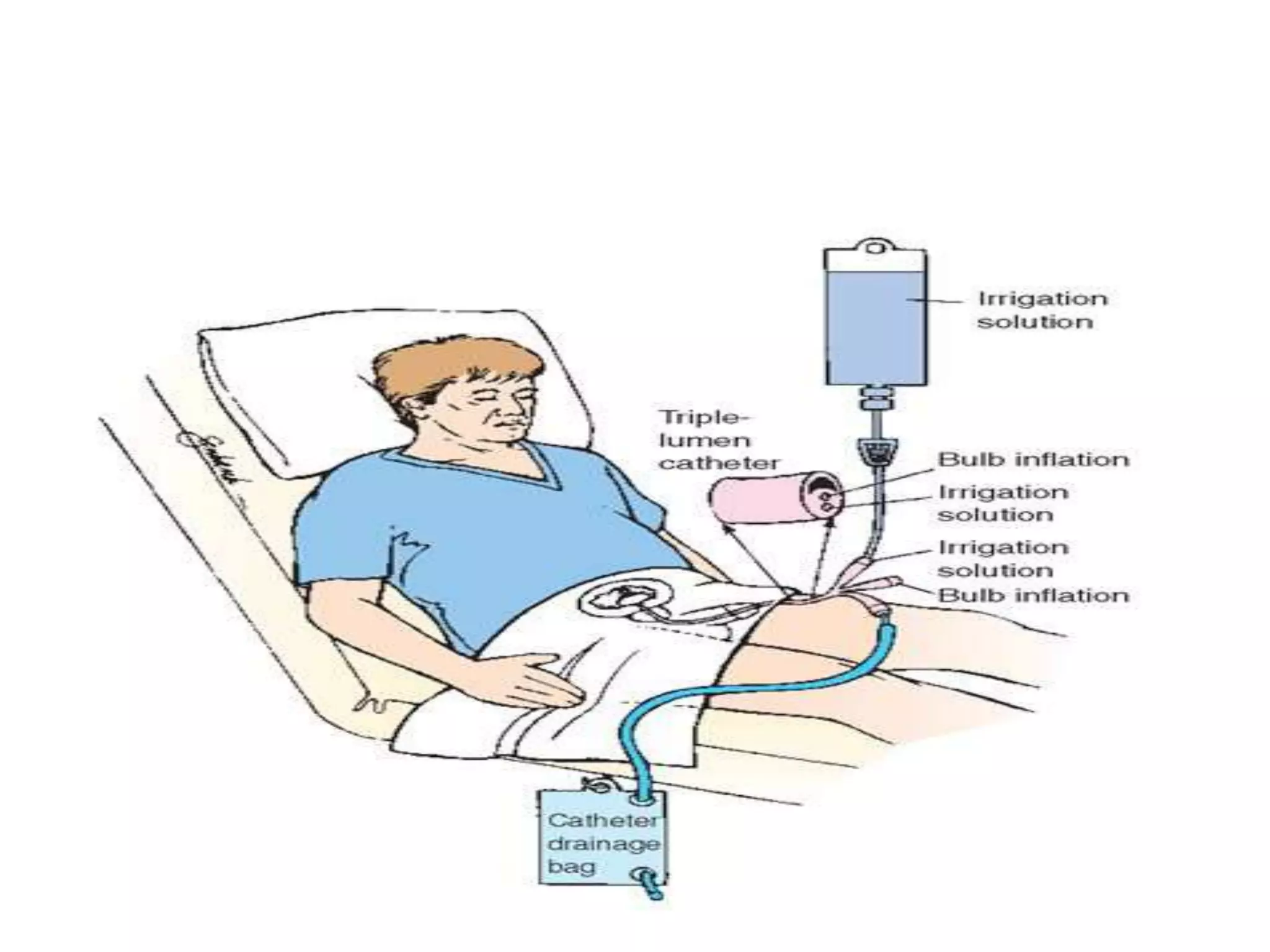 Bladder irrigation | PPTX