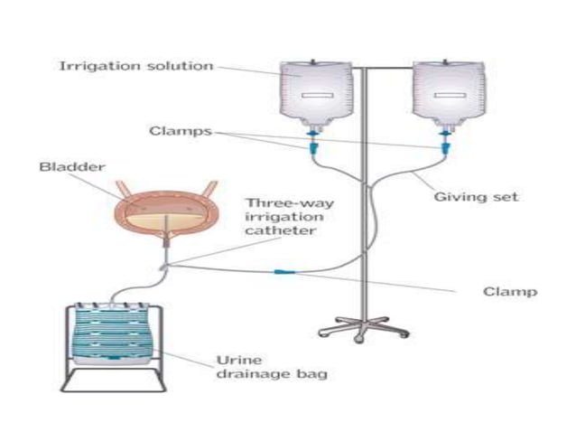 Bladder irrigation | PPTX | First Aid | Injuries