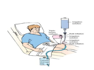 Continuous Bladder Irrigation