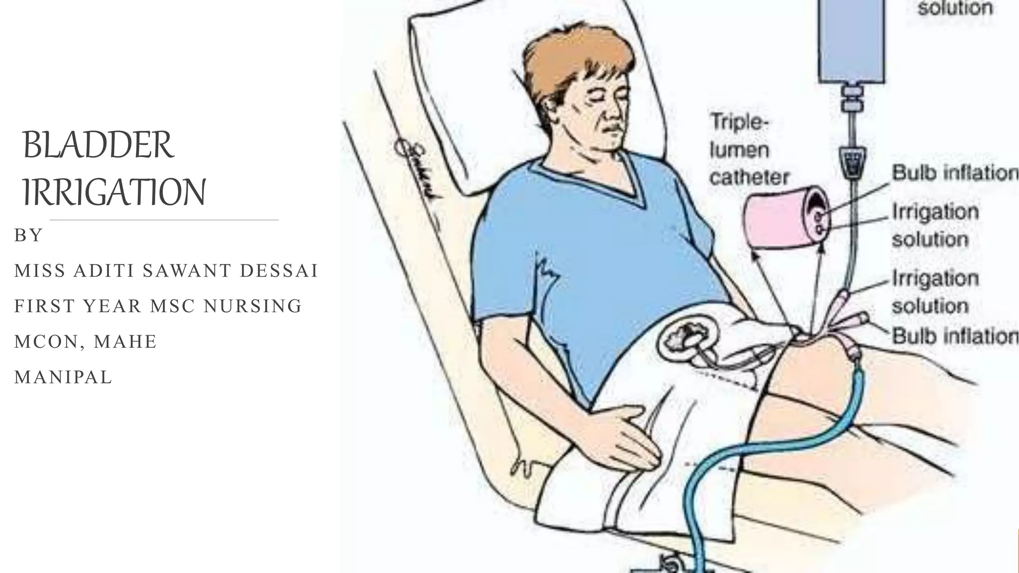 Bladder irrigation | PPTX