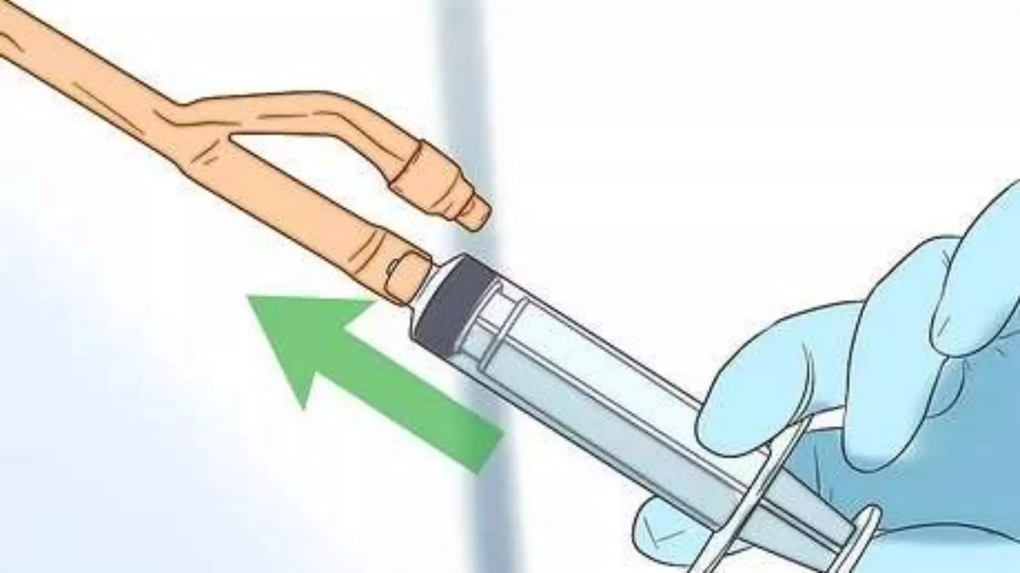 Bladder irrigation | PPTX