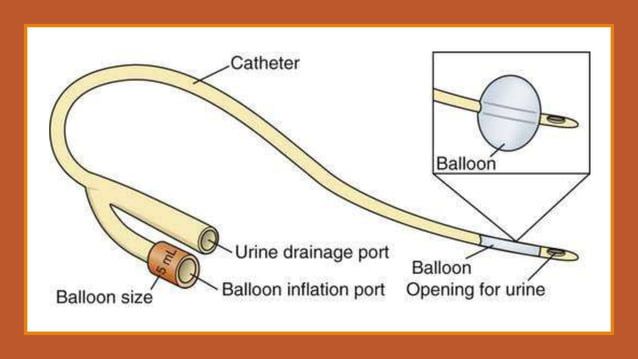 Bladder irrigation | PPTX