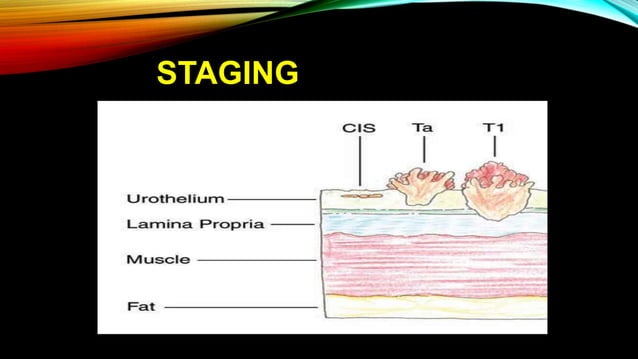 Bladder mass clinical features & staging | PPTX