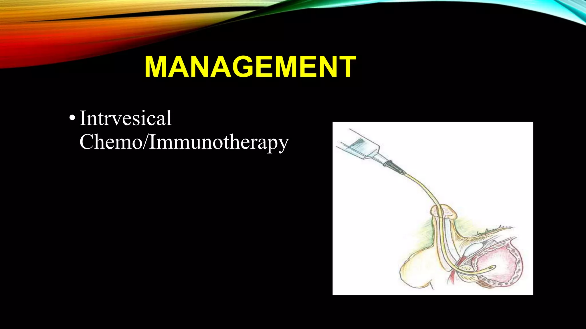 Bladder cancer management | PPTX