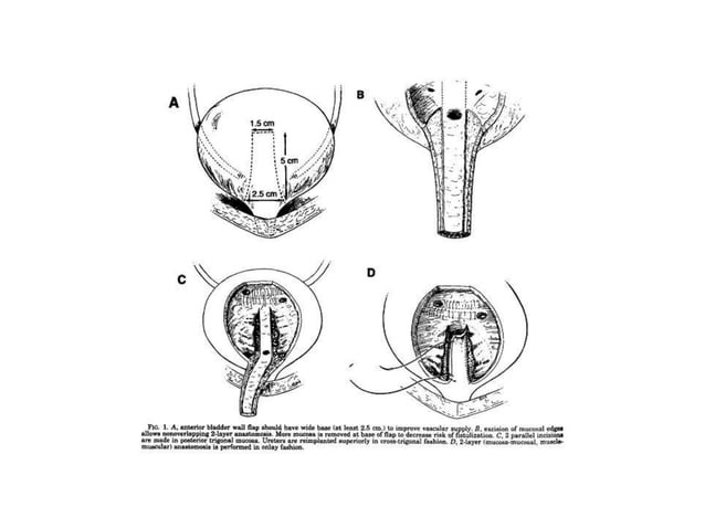 Bladder neck reconstruction | PPTX