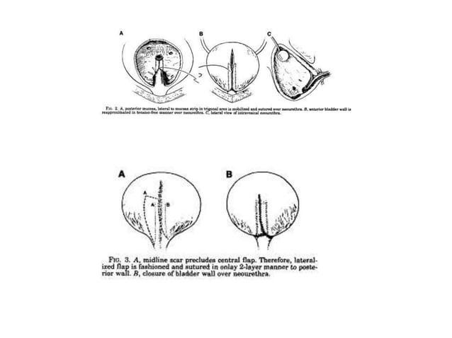 Bladder neck reconstruction | PPTX