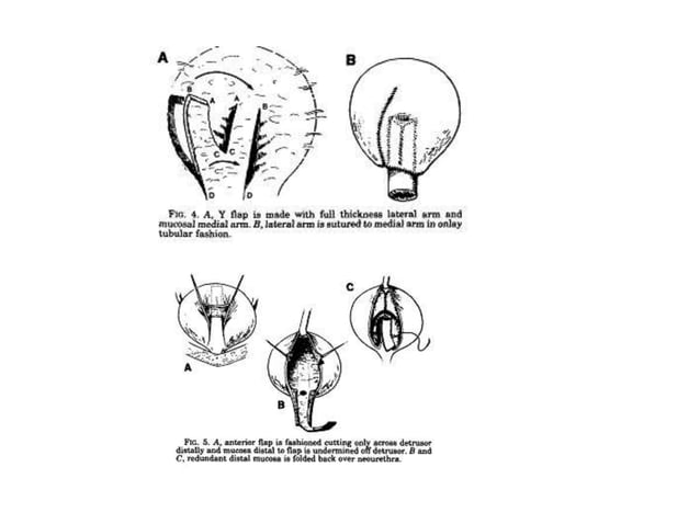 Bladder neck reconstruction | PPTX