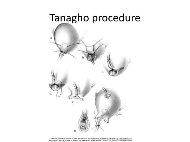 Bladder neck reconstruction | PPTX
