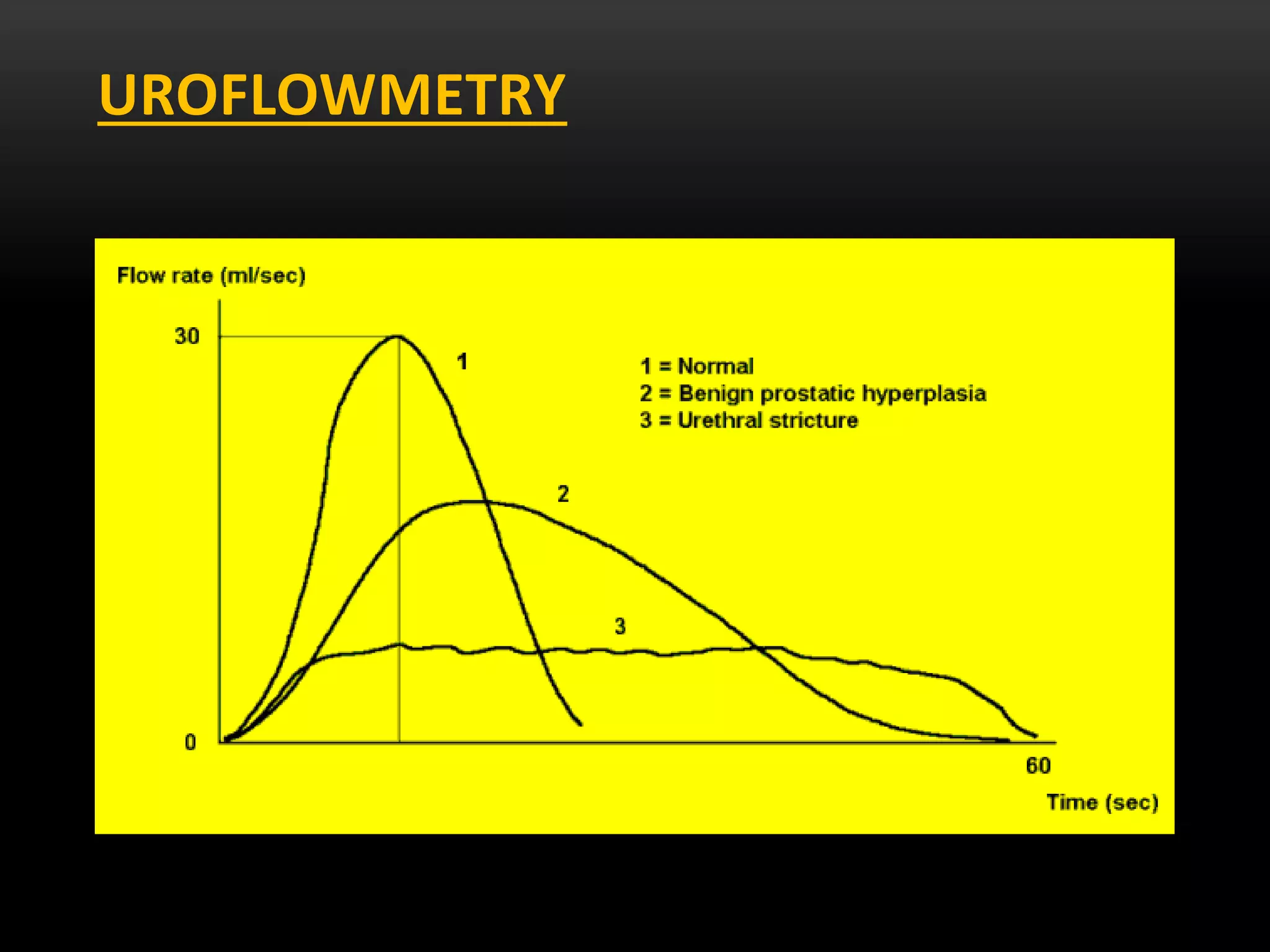Bladder outflow obstruction.ppt