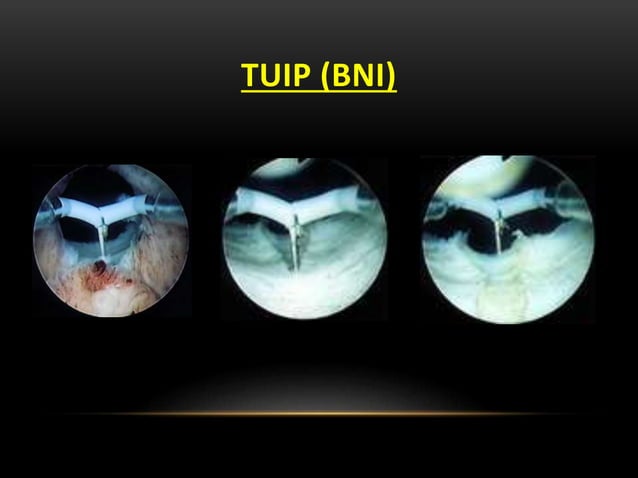 Bladder outflow obstruction.ppt