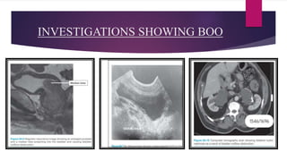 BLADDER OUTFLOW OBSTRUCTION(BOO) PPT.pptx