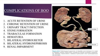 BLADDER OUTFLOW OBSTRUCTION(BOO) PPT.pptx