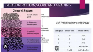 BLADDER OUTFLOW OBSTRUCTION(BOO) PPT.pptx