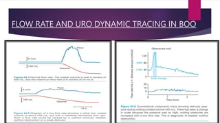BLADDER OUTFLOW OBSTRUCTION(BOO) PPT.pptx