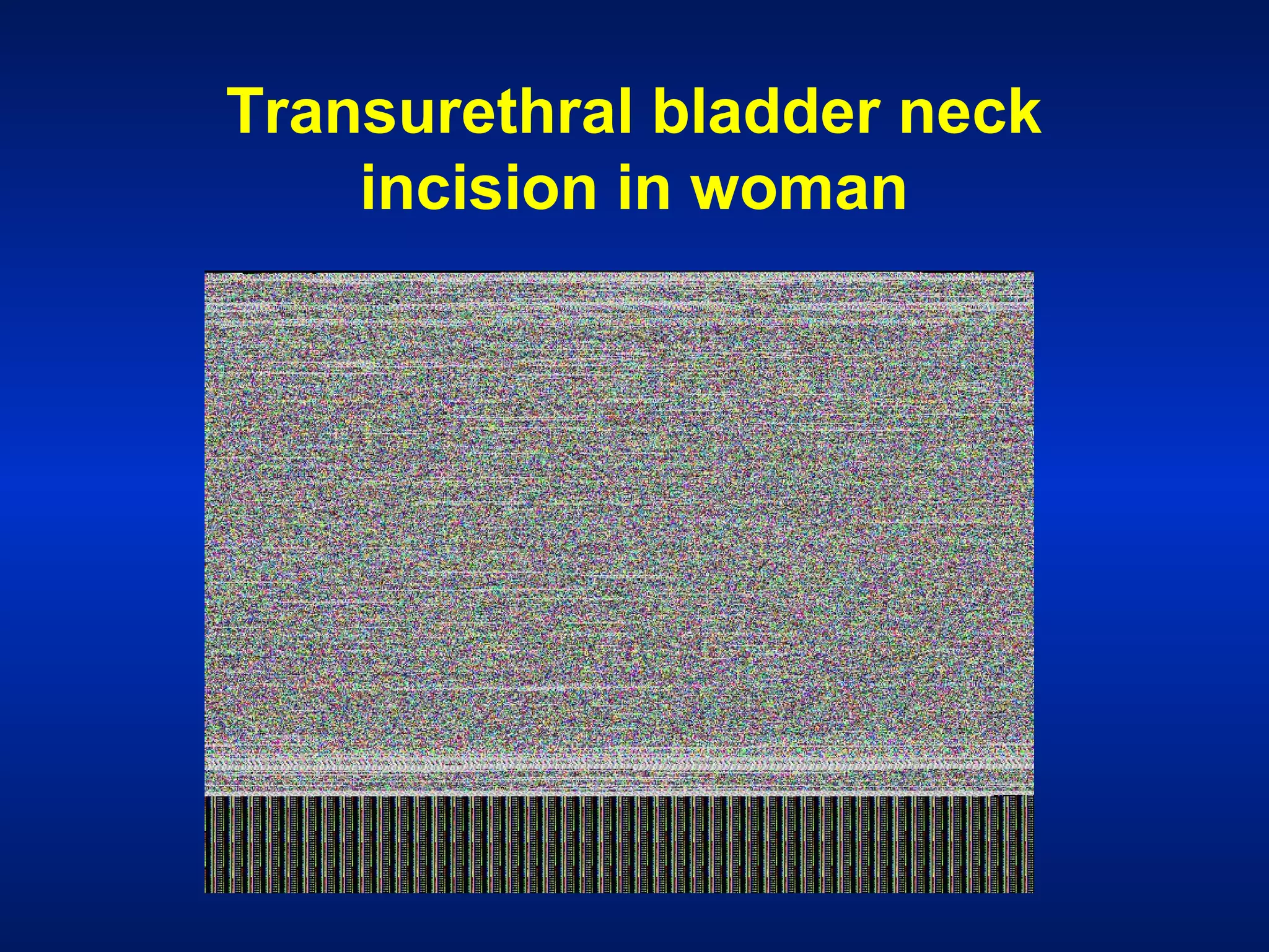 Bladder Outlet Obstruction in Women - Diagnostics and Therapy | PPT