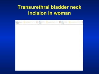 Bladder Outlet Obstruction in Women - Diagnostics and Therapy | PPT