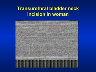 Bladder Outlet Obstruction in Women - Diagnostics and Therapy | PPT