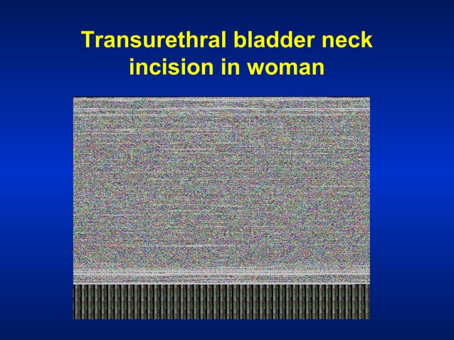 Bladder Outlet Obstruction in Women - Diagnostics and Therapy | PPT