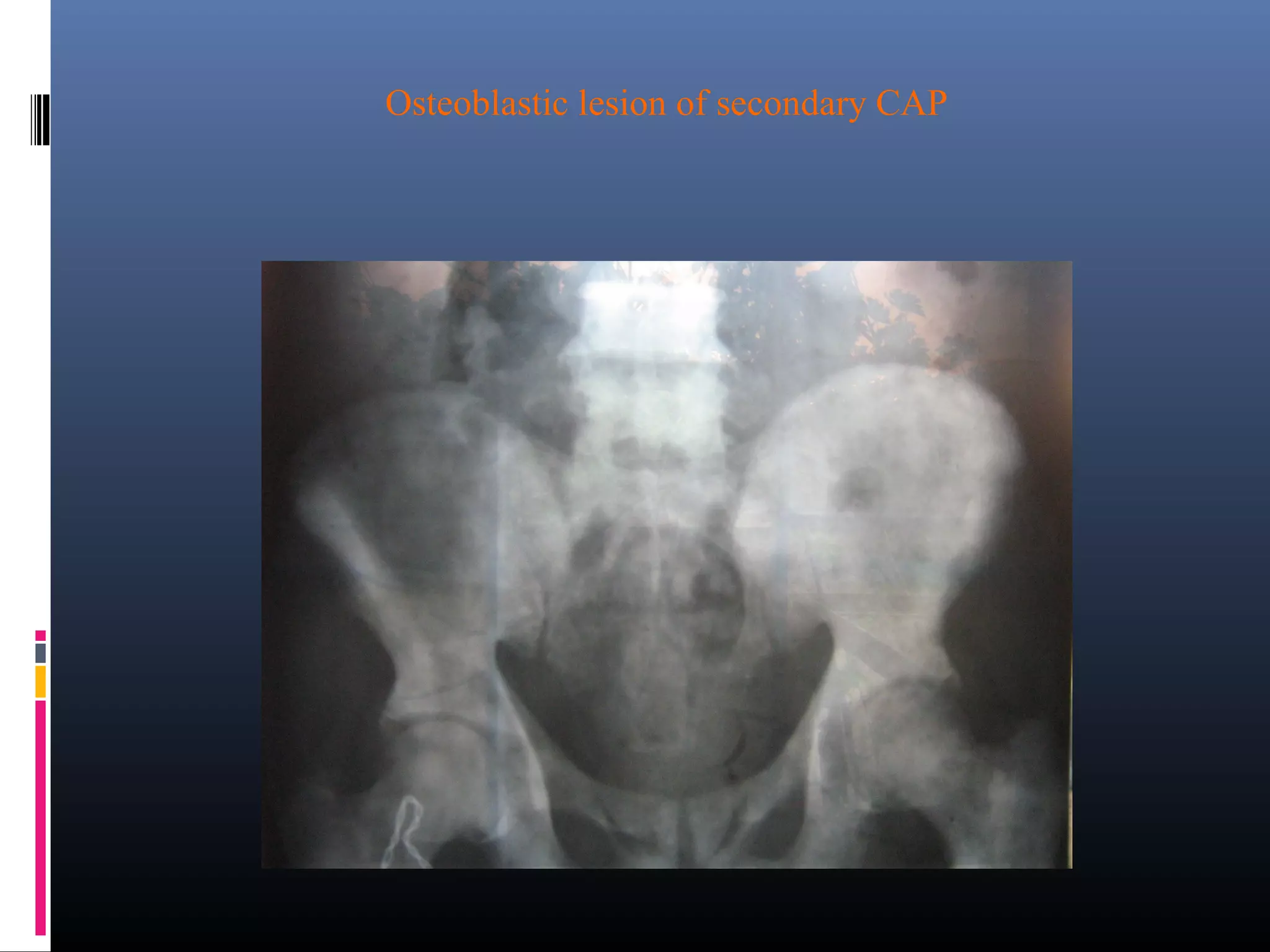 Bladder outlet obstruction | PPT