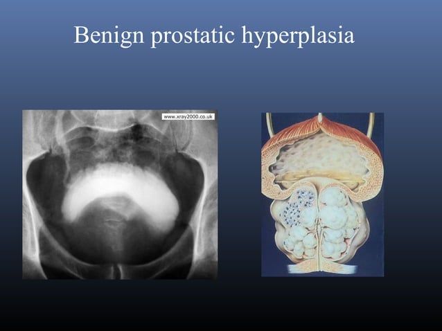Bladder outlet obstruction | PPT