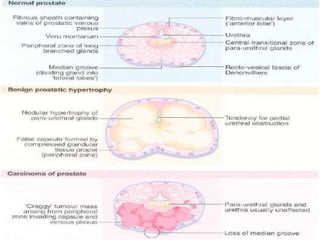 Bladder Outlet Obstruction (BOO).pptx