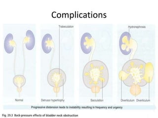 Bladder Outlet Obstruction (BOO).pptx