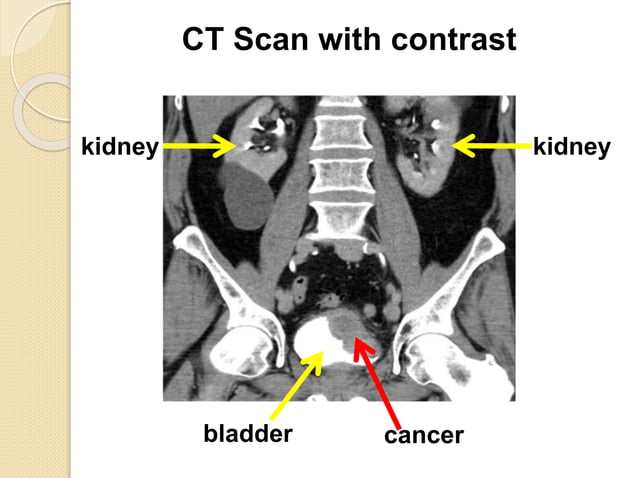 Cancer of the Bladder | PPTX