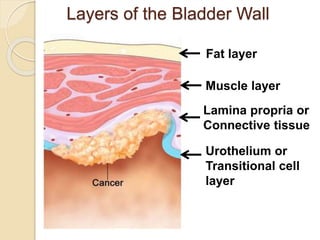 Cancer of the Bladder | PPTX
