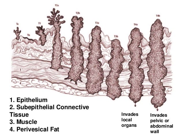 Cancer of the Bladder