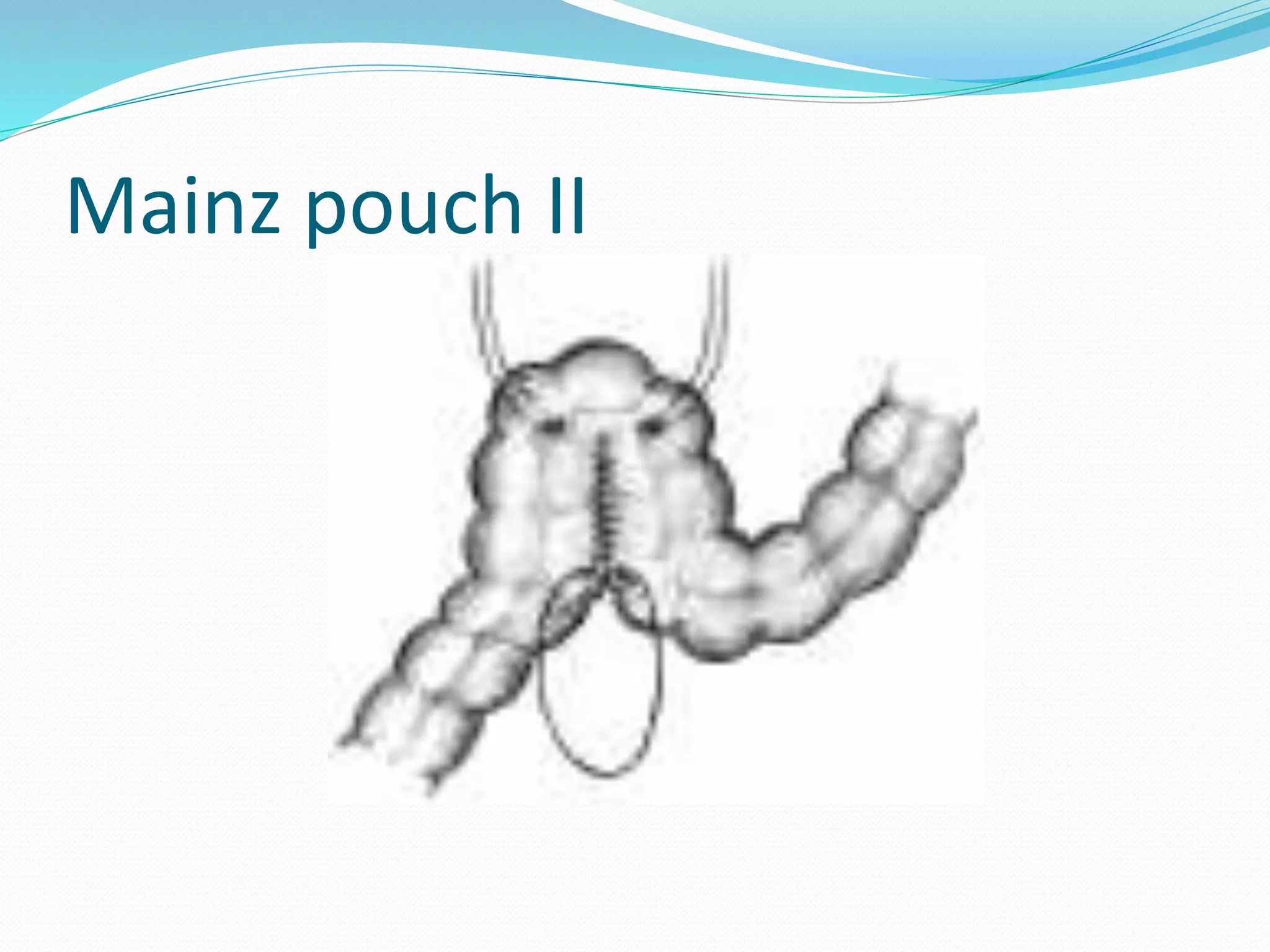 Bladder cancer surgery | PPTX