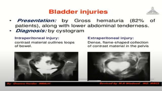 Bladder Trauma.pptx