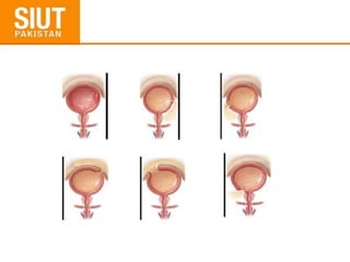 Bladder trauma ff.pptx