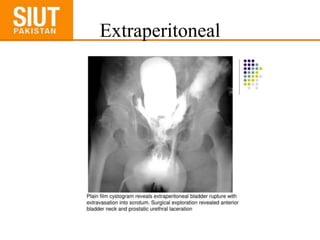 Bladder trauma ff.pptx