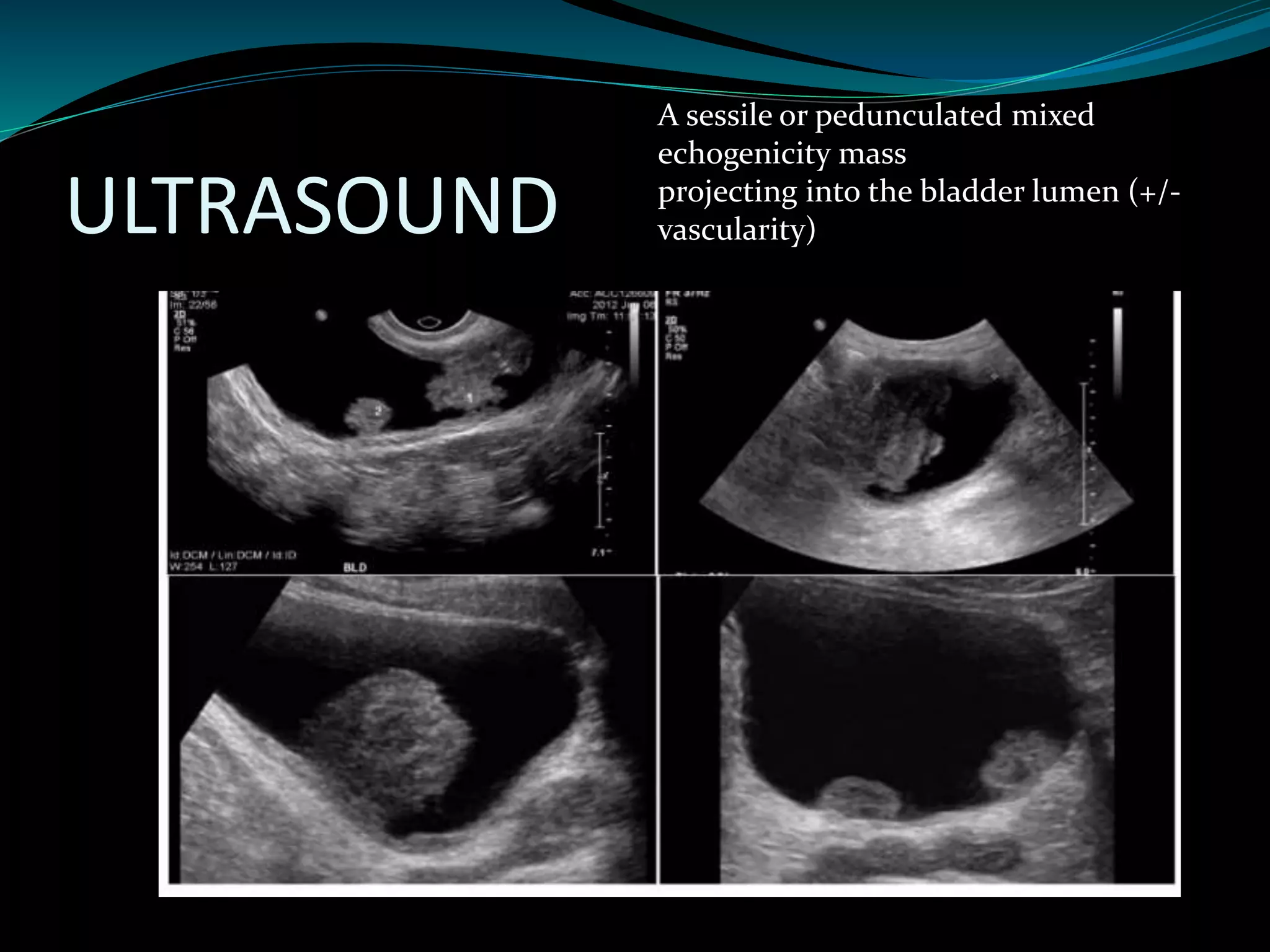 IMAGING OF CARCINOMA OF URINARY BLADDER | PPTX