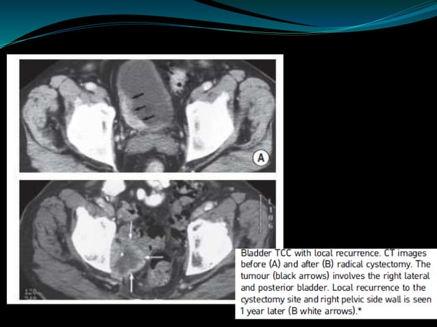 IMAGING OF CARCINOMA OF URINARY BLADDER | PPTX | Cancer | Diseases and ...