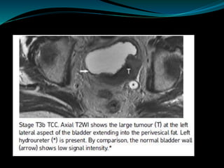 IMAGING OF CARCINOMA OF URINARY BLADDER | PPTX