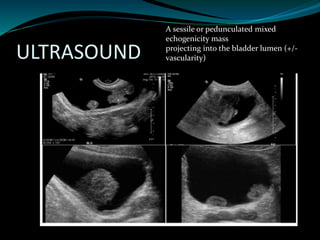 IMAGING OF CARCINOMA OF URINARY BLADDER | PPTX