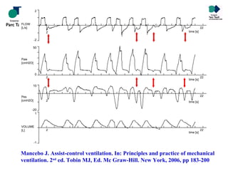 Under Appreciated Signs In Ventilator Monitoring | PPT