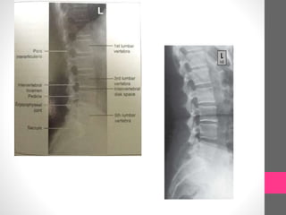Final Image Evaluation: Left Lateral Lumbar Spine | PPTX
