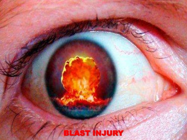 Blast injuries | PPTX | First Aid | Injuries