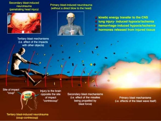 Blast injuries