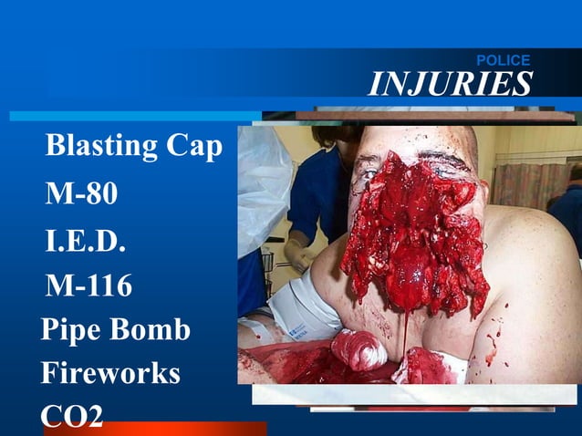 Blast injuries
