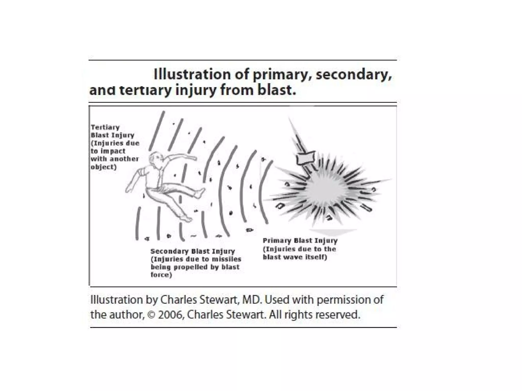 Blast injuries | PPT