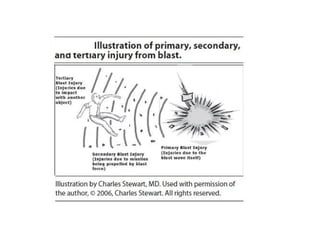 Blast injuries | PPT